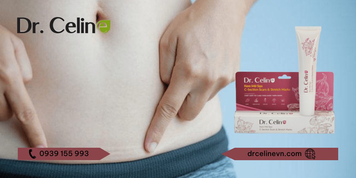 Kem mờ sẹo Dr. Celine C-Section Scars and Stretch Marks (Tuýp 15g) - Dr. Celine